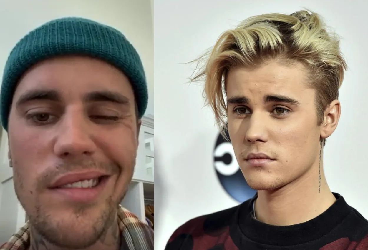 Justin Bieber is Suffering from Ramsay Hunt as Paralyzed Half His Face